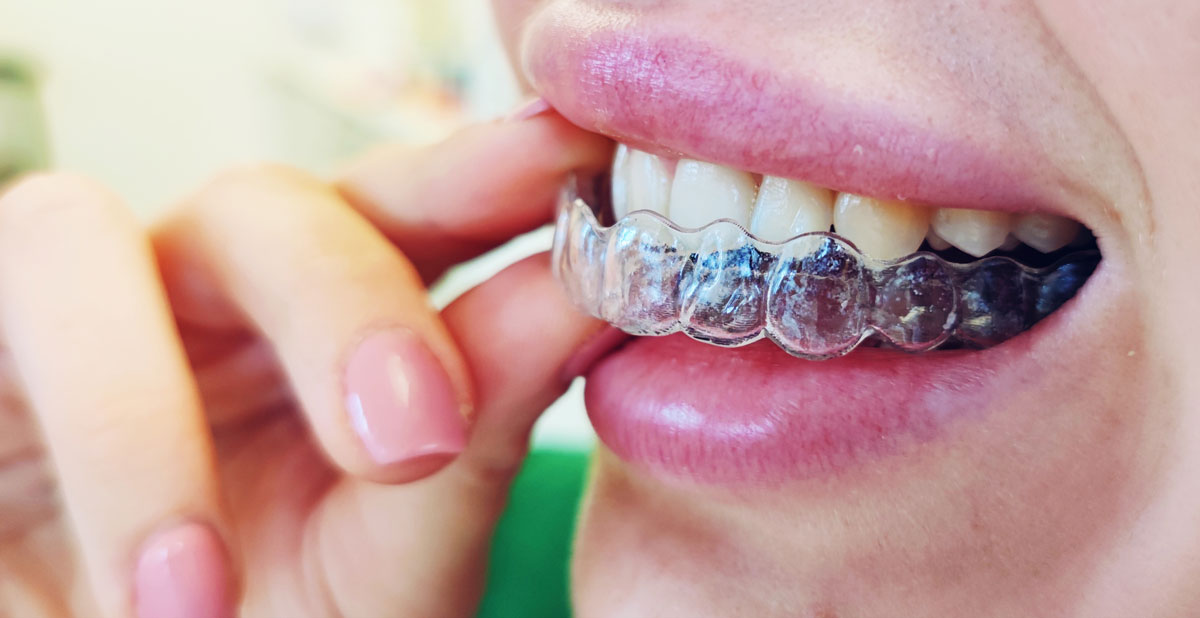 Die optimale Tragezeit für Aligner